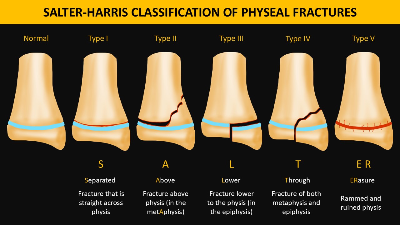 Salter Harris Fracture Grading